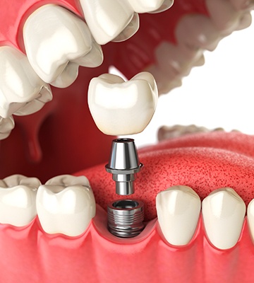 Single Implant Crowns Colleyville | Dental Implants